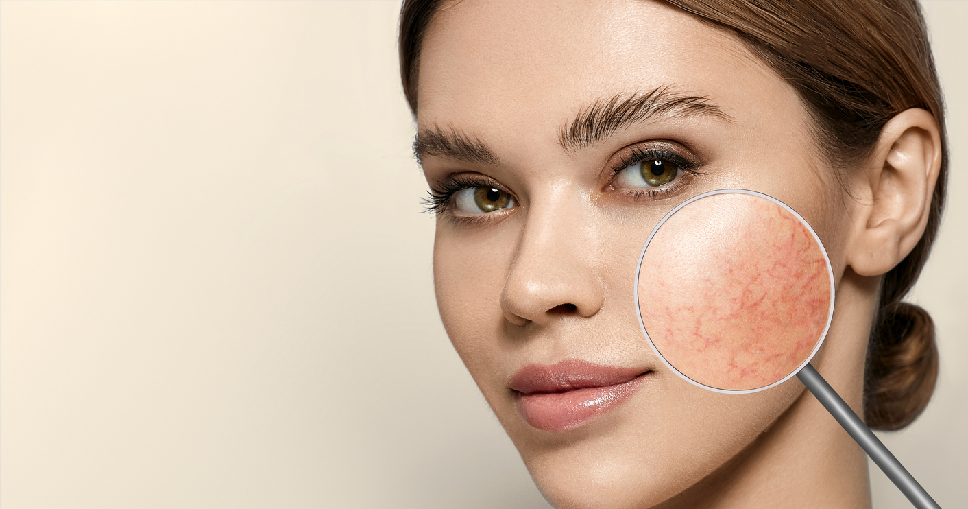The Importance Of Skin Care In Rosacea Treatment - Good Life Family ...